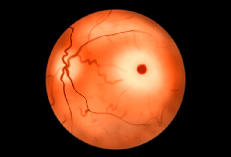 Degenerescência Macular (DMI) - Clínica Privada de Oftalmologia